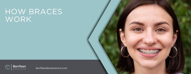 Braces: Types, What to Expect, How They Work… | Benfleet Dental Centre